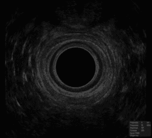 Endo-anal ultrasound: Expert Imaging of the Anal Muscles - Dr. Katalin ...