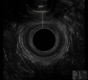 Endo-anal ultrasound: Expert Imaging of the Anal Muscles - Dr. Katalin ...