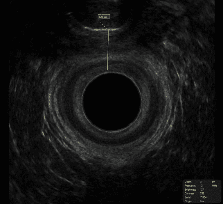 Endo-anal ultrasound: Expert Imaging of the Anal Muscles - Dr. Katalin ...